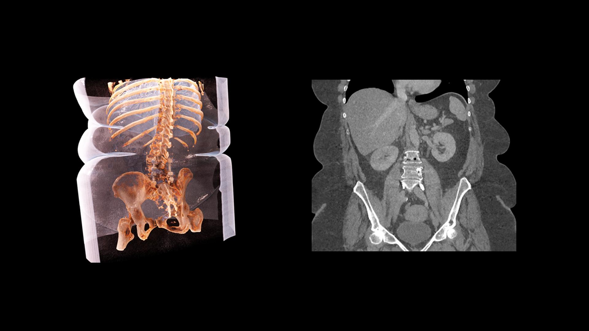 SOMATOM Definition Edge - Siemens Healthineers India