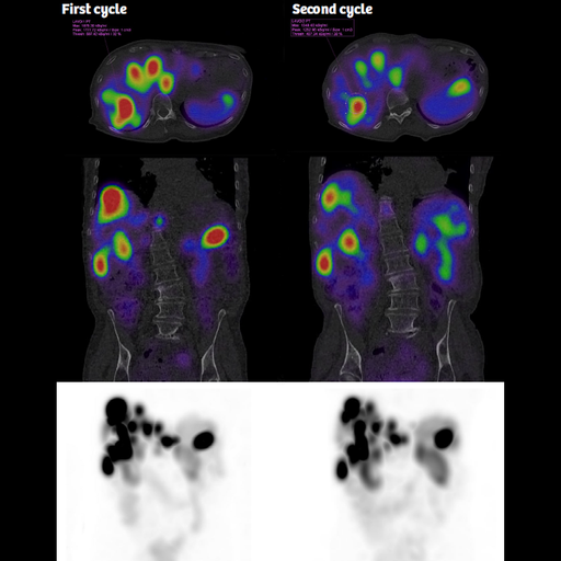Evaluating SPECT/CT Quantification in Clinical Practice - Siemens Healthineers
