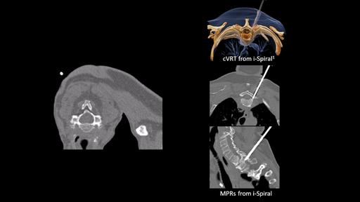 CT-guided interventions - Siemens Healthineers