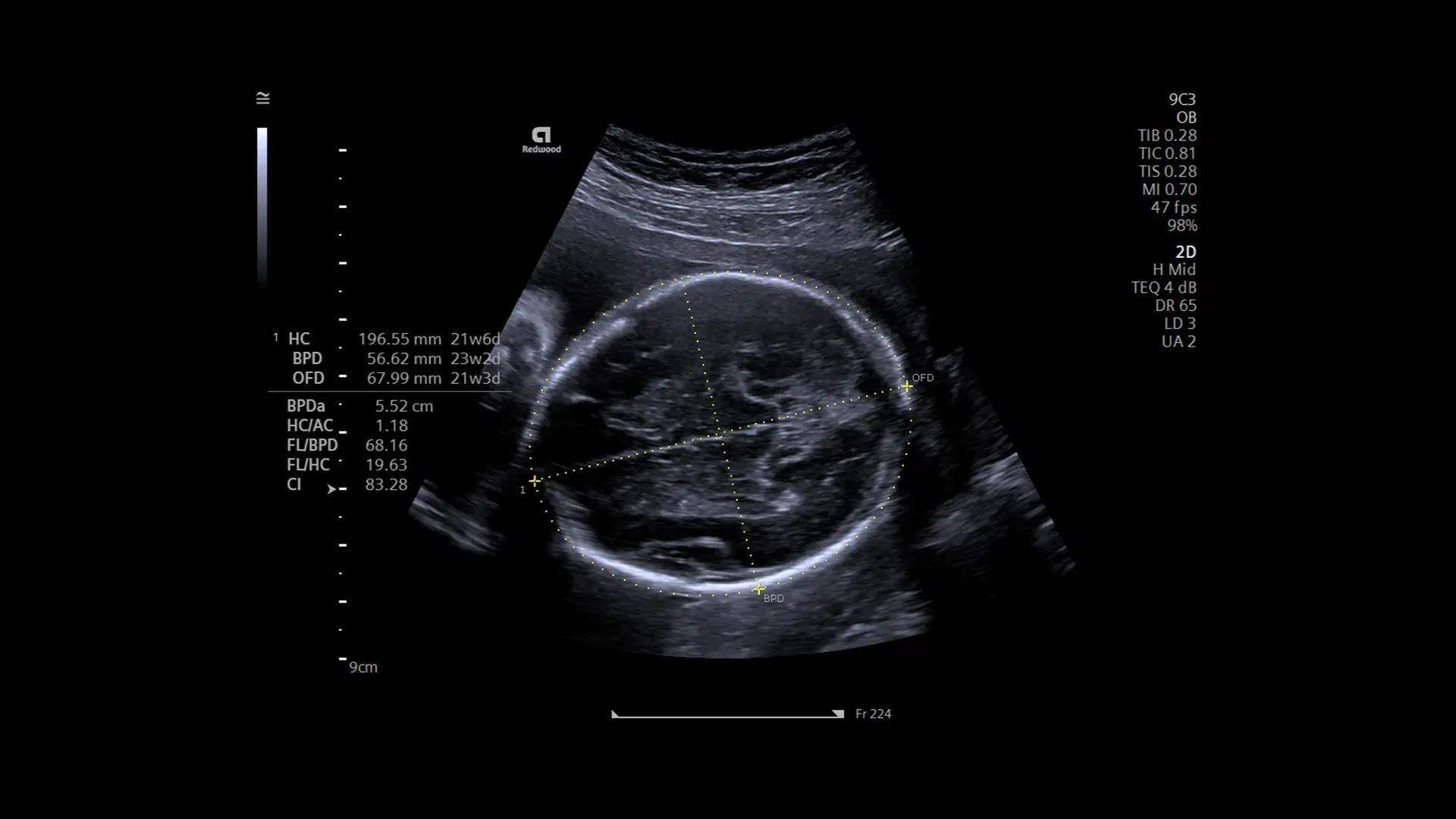 ACUSON Redwood Ultrasound System - Siemens Healthineers
