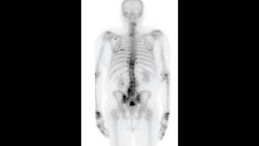 SPECT/CT imaging in the evaluation of pain following spinal fusion ...