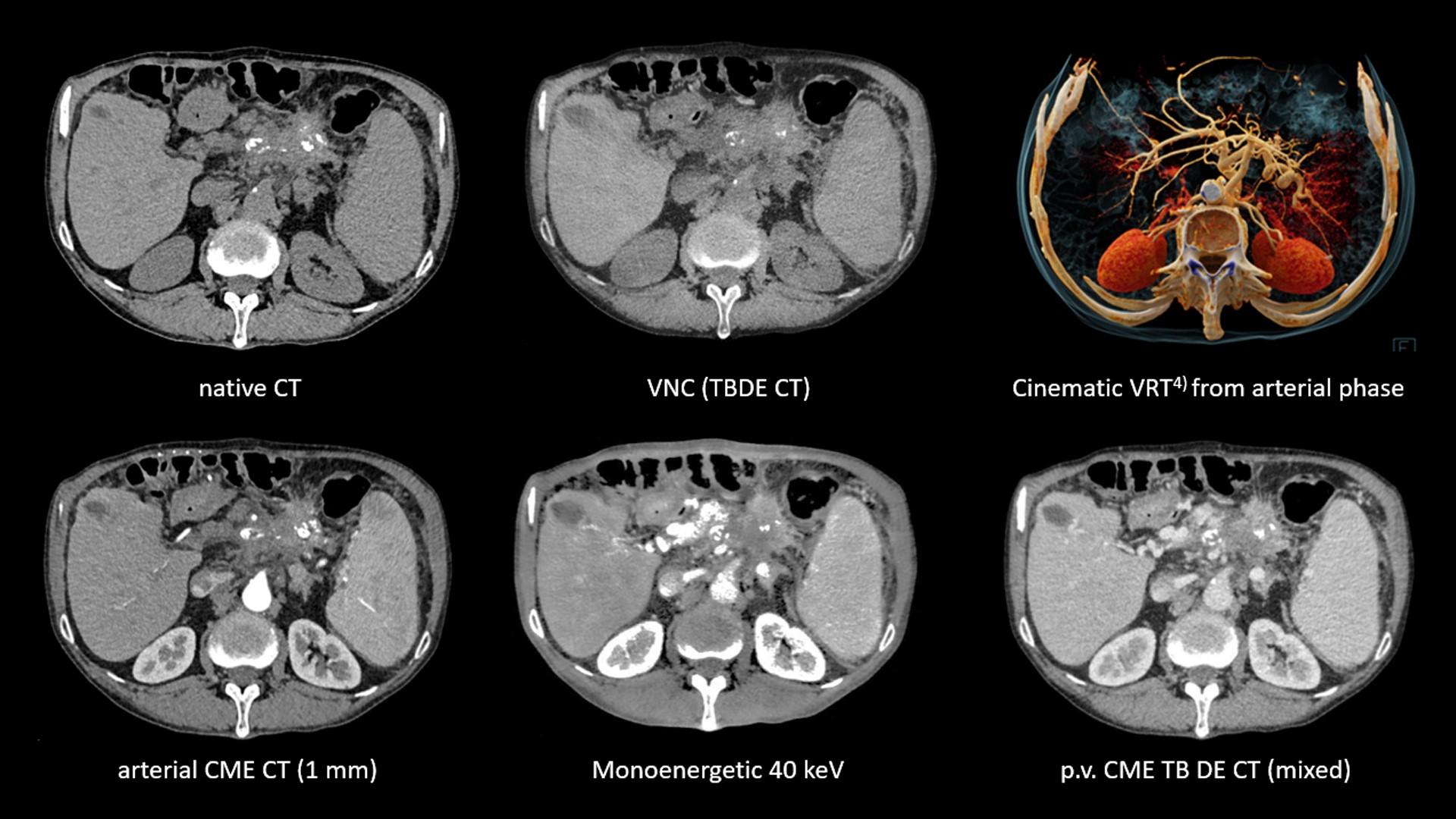 SOMATOM go.Top – Made to match - Siemens Healthineers