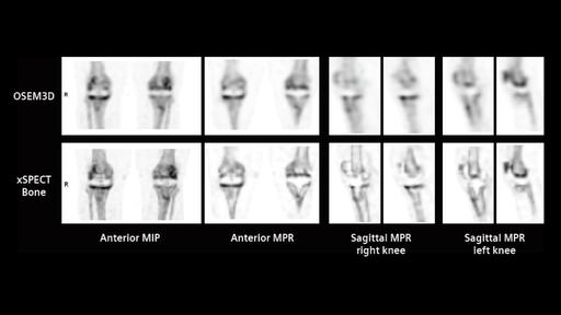 SPECT/CT Detection In TKA Prosthetic Loosening - Siemens Healthineers USA