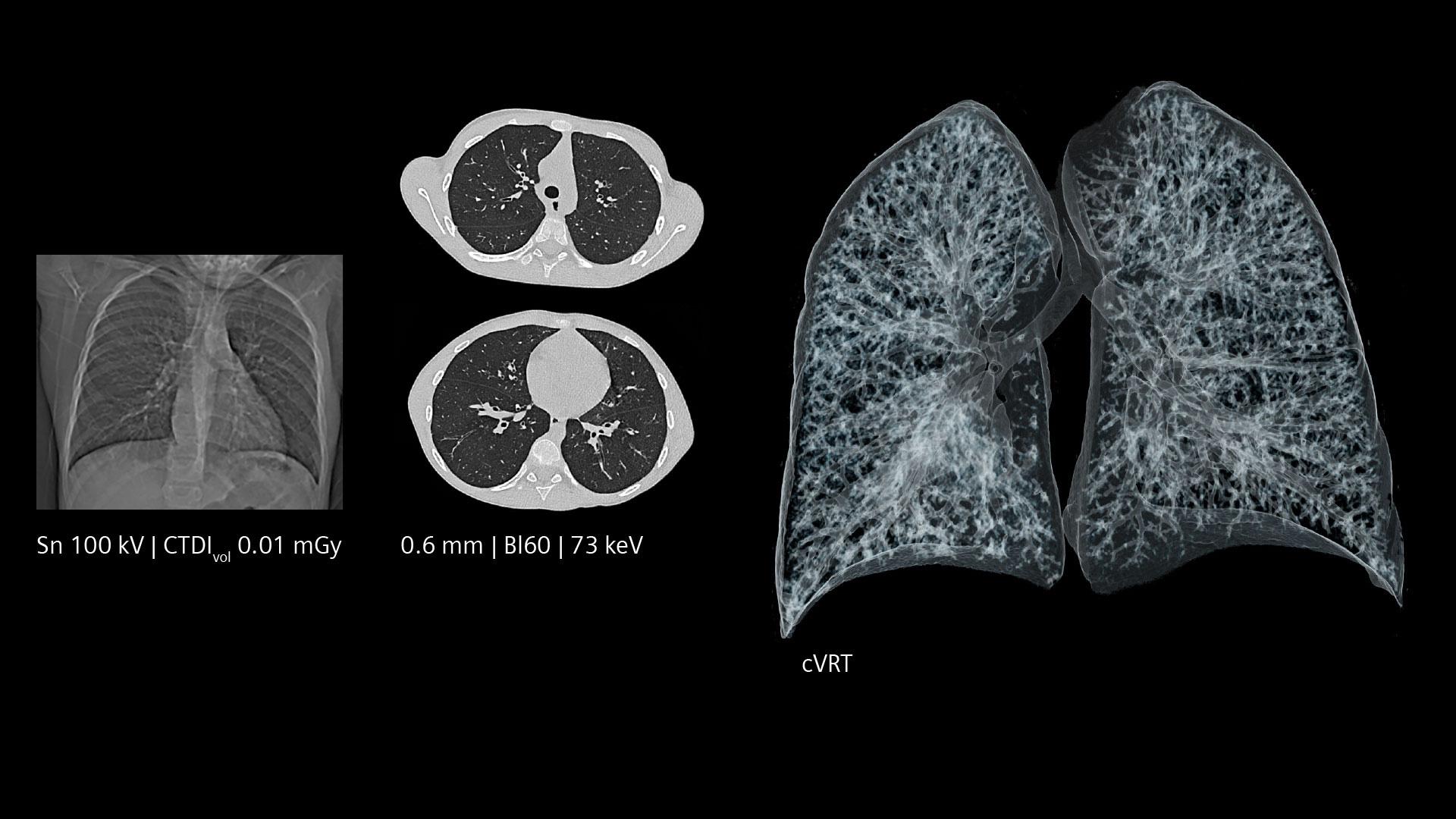 PCCT pediatric imaging - Siemens Healthineers USA