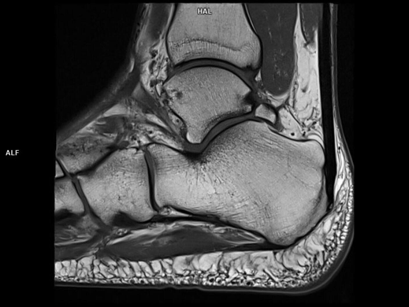 Sagittal T1 TSE-MAGNETOM Lumina - Siemens Healthineers USA