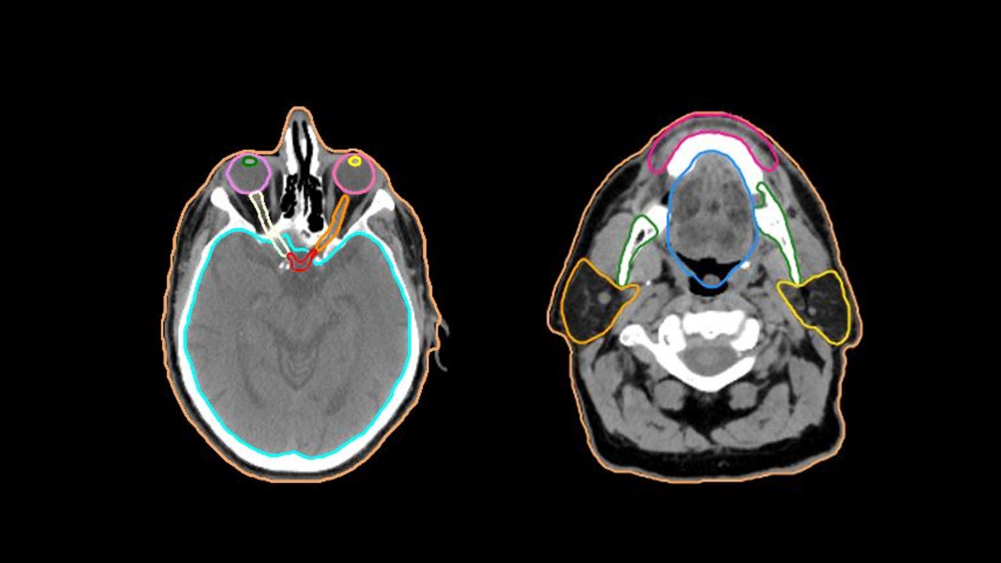 Autocontouring in Radiation Therapy - Siemens Healthineers - Siemens ...