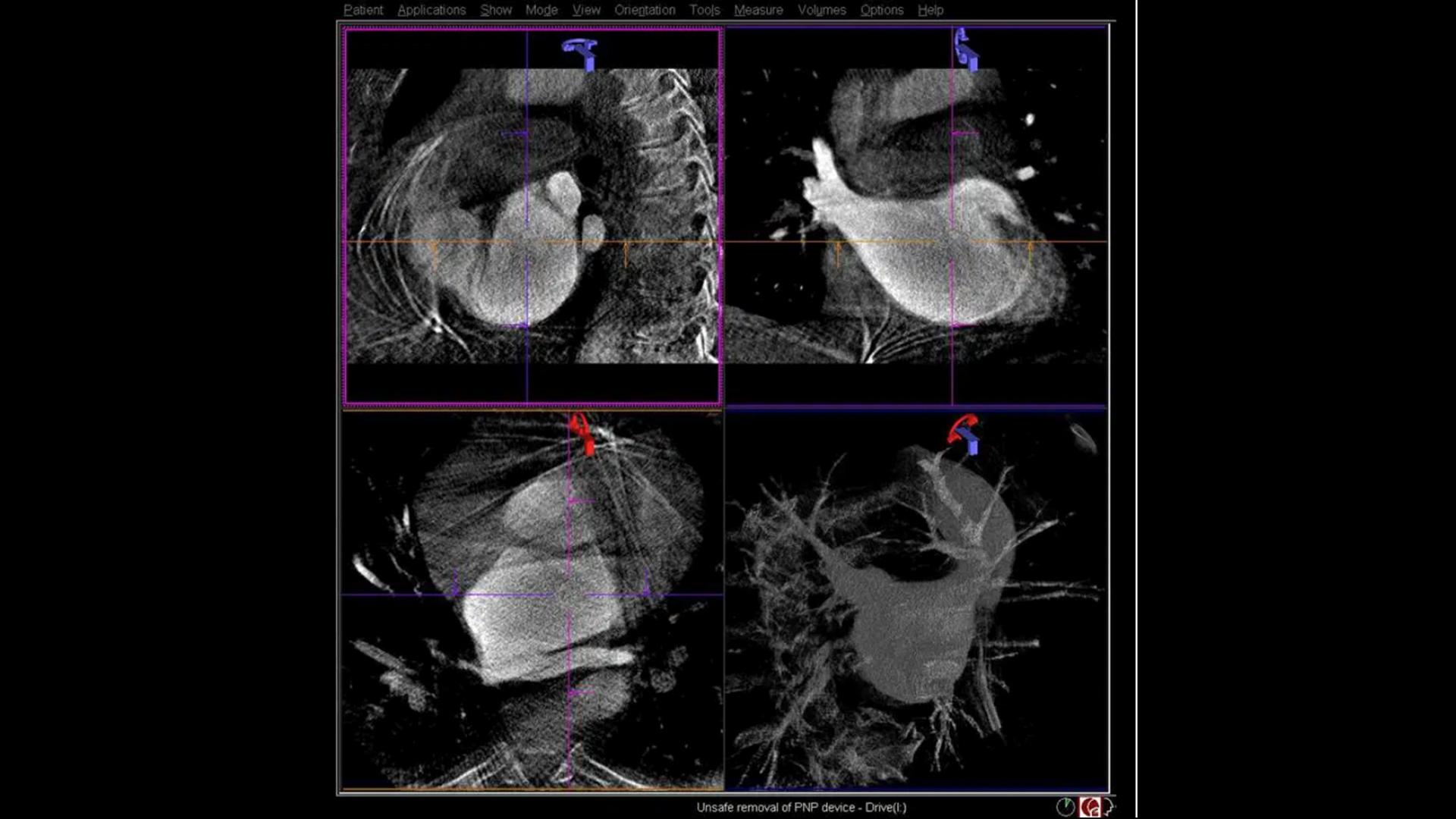 syngo DynaCT - Siemens Healthineers USA