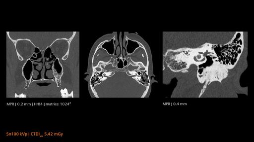 NAEOTOM Alpha - applications neurologiques - Siemens Healthineers France