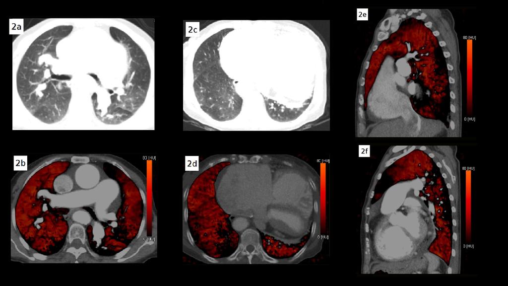 Chronic thromboembolic pulmonary hypertension - Siemens Healthineers