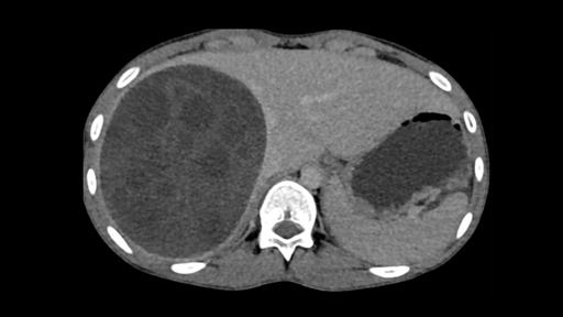 Cystic echinococcosis in a child - Siemens Healthineers