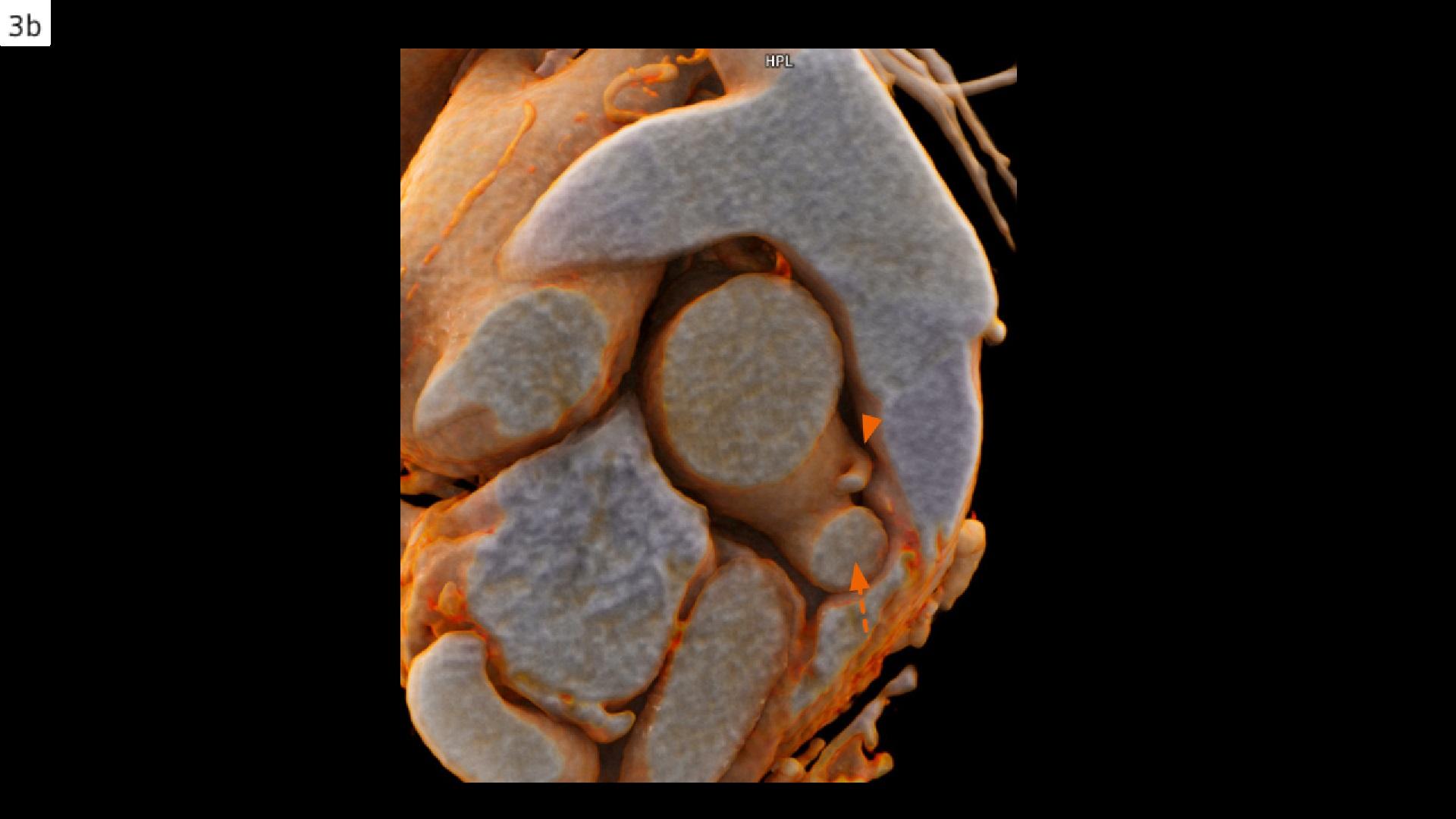 Bland-White-Garland syndrome in an adult - Siemens Healthineers