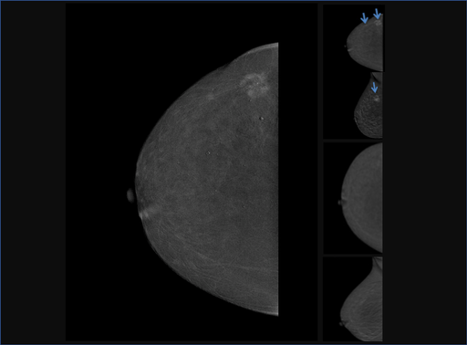Titanium Contrast Enhanced Mammography (TiCEM) with 50° Wide-Angle HD ...