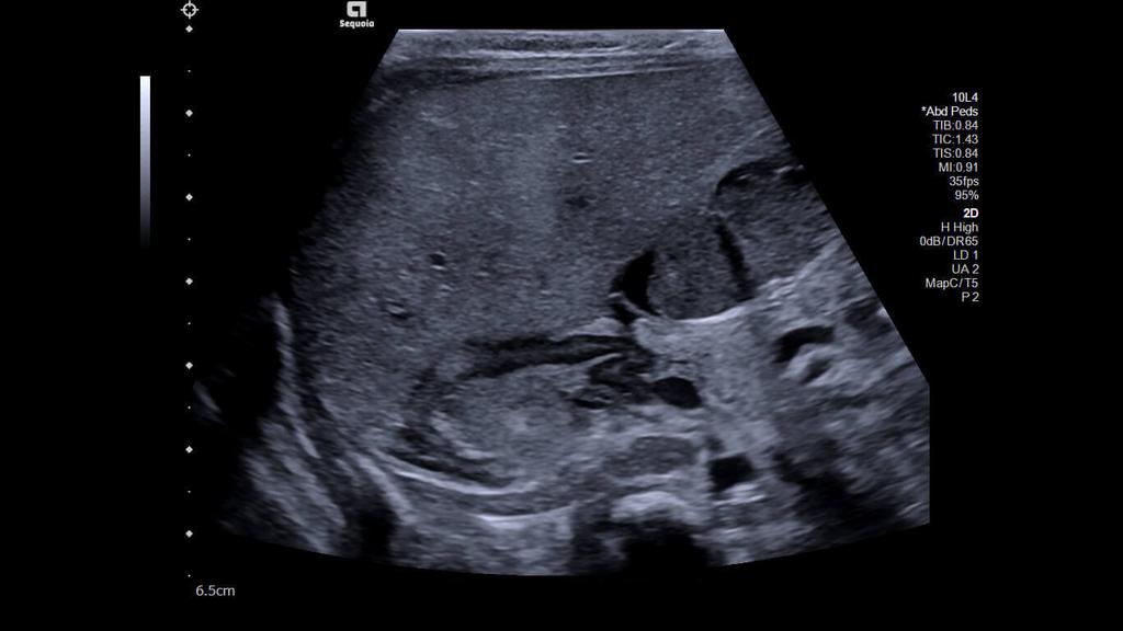 ACUSON Sequoia Ultrasound Machine for Pediatrics - Siemens Healthineers