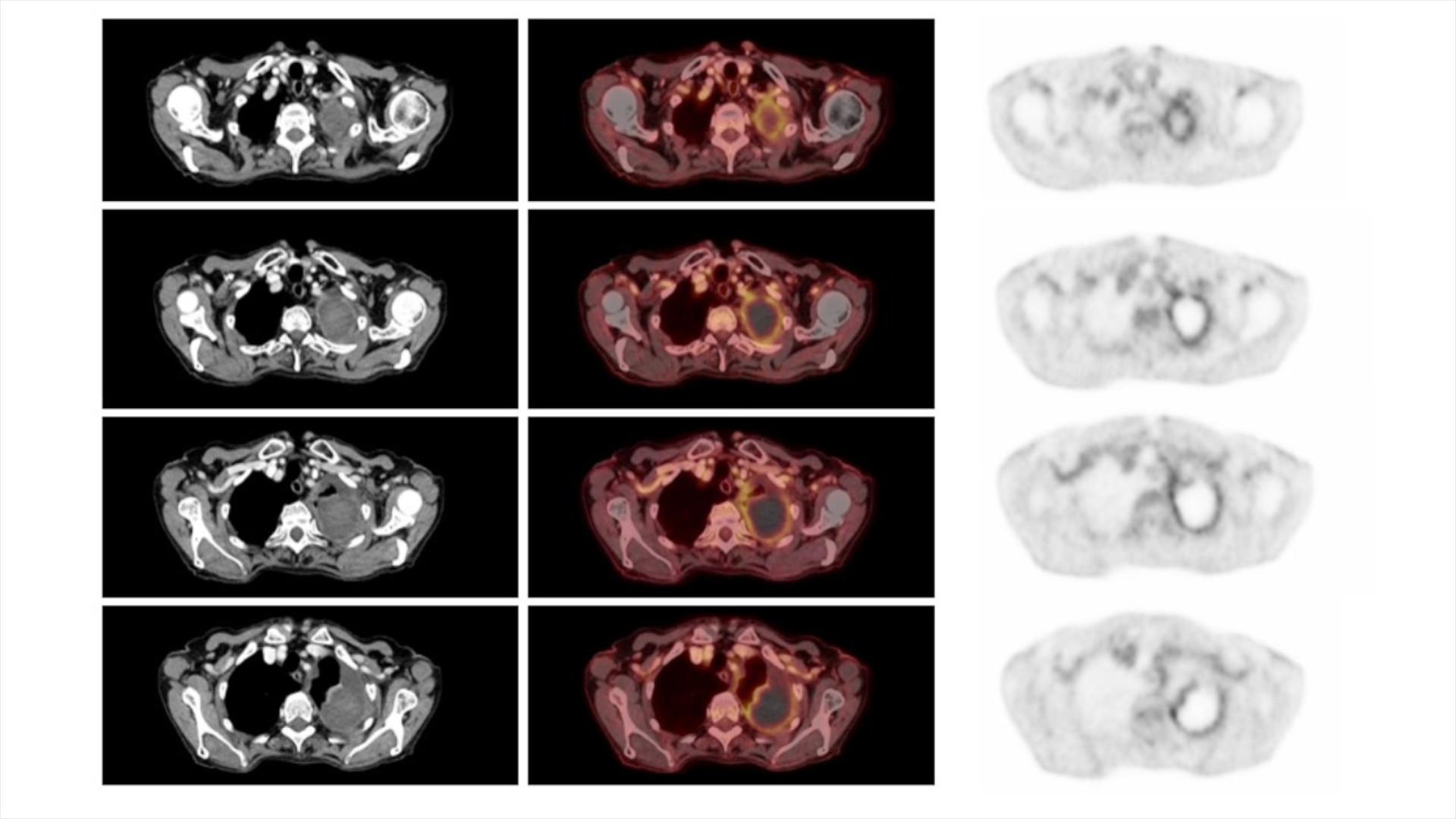 18F-FDG PETCT delineation of predominantly pericardial involvement in ...