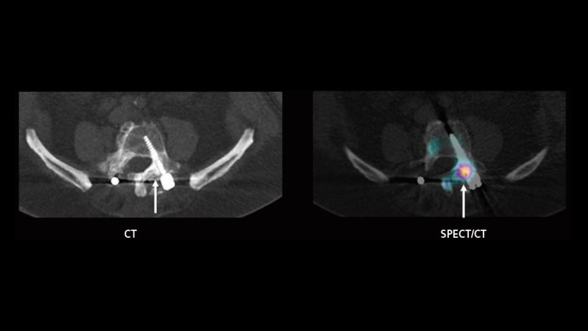 SPECT/CT imaging in the evaluation of pain following spinal fusion ...