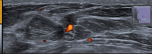 Invasive Ductal Carcinoma (IDC) - Role of Tomosynthesis in IDC early ...