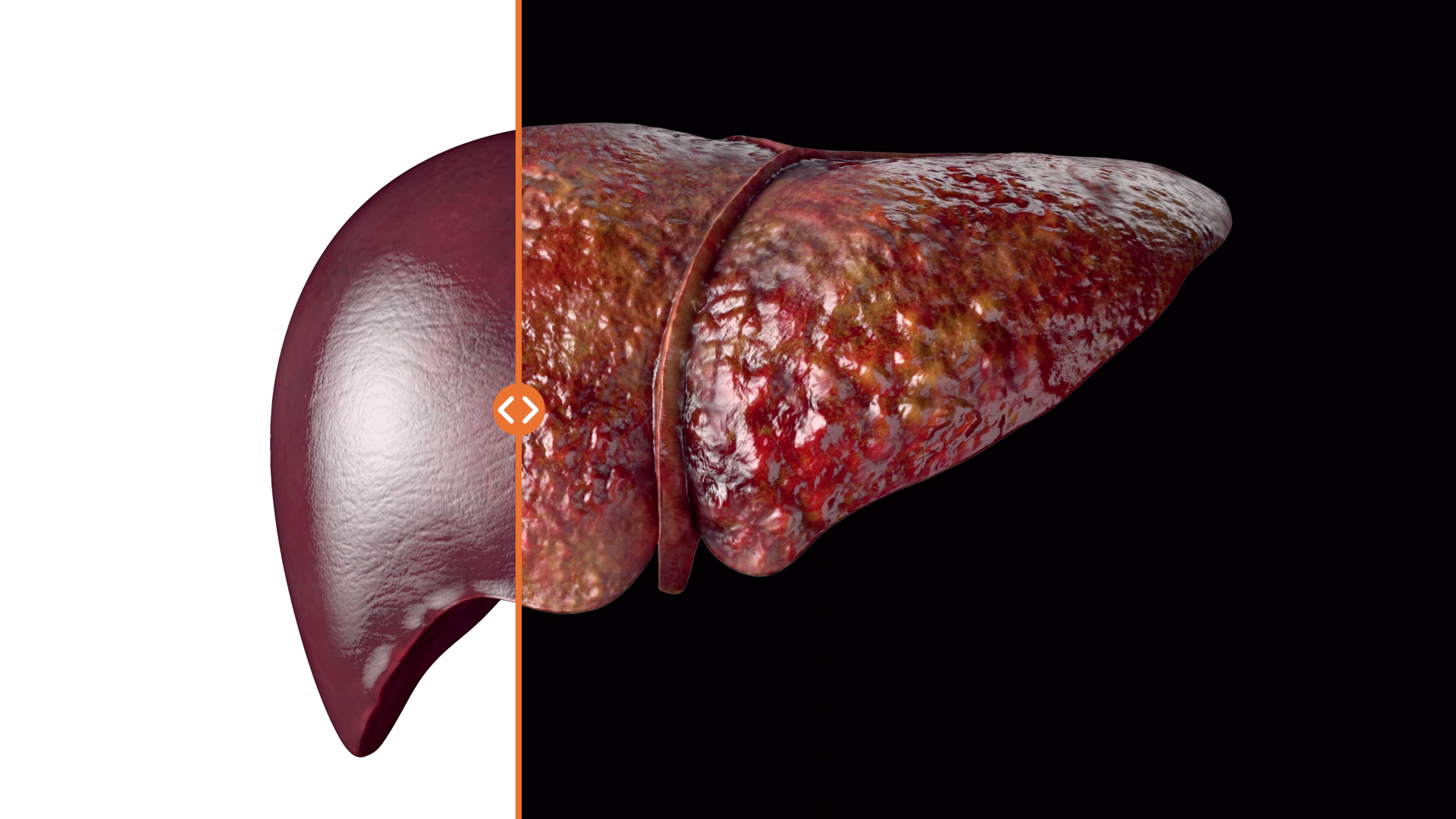 ¿Qué es la fibrosis hepática? - Siemens Healthineers Latinoamérica