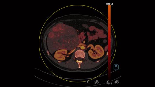 Liver Cancer Management - Siemens Healthineers