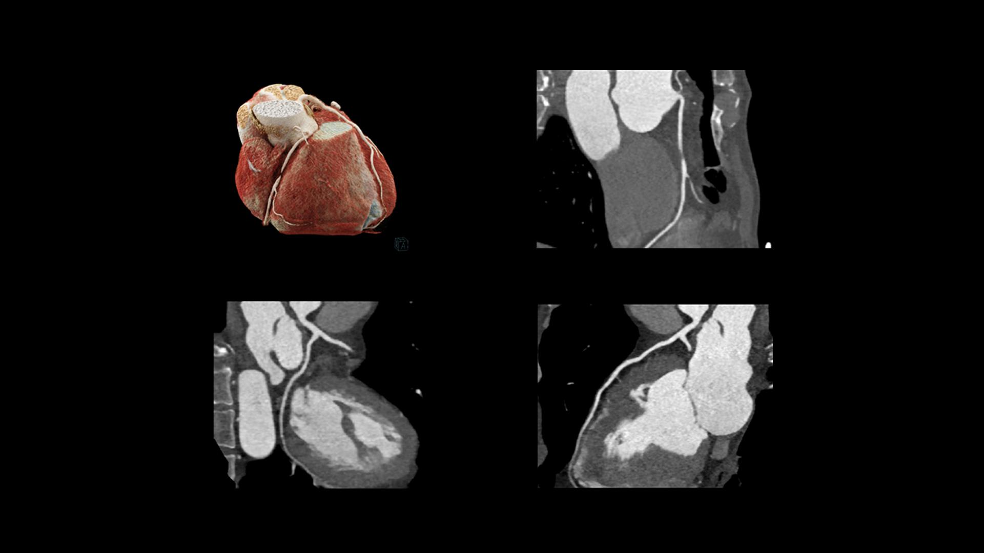SOMATOM Definition Edge - Siemens Healthineers India