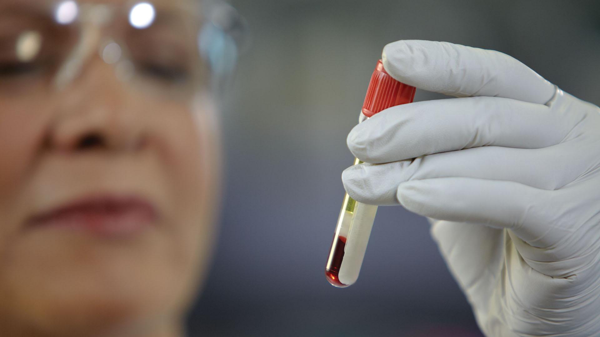 Serum free light chains testing in monoclonal gammopathies - Siemens ...