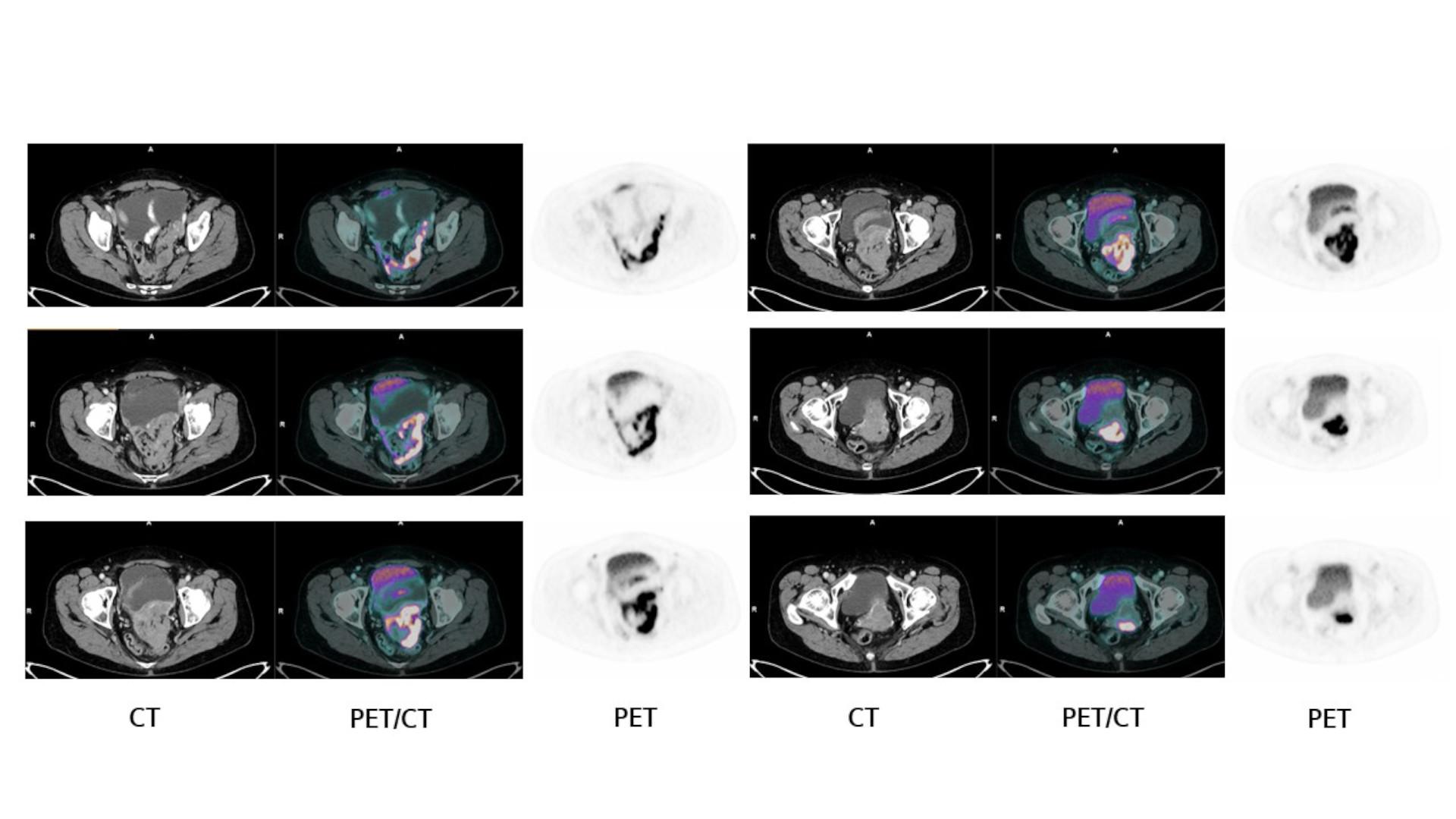 18F-FDG delineation of peritoneal carcinomatosis in ovarian carcinoma ...