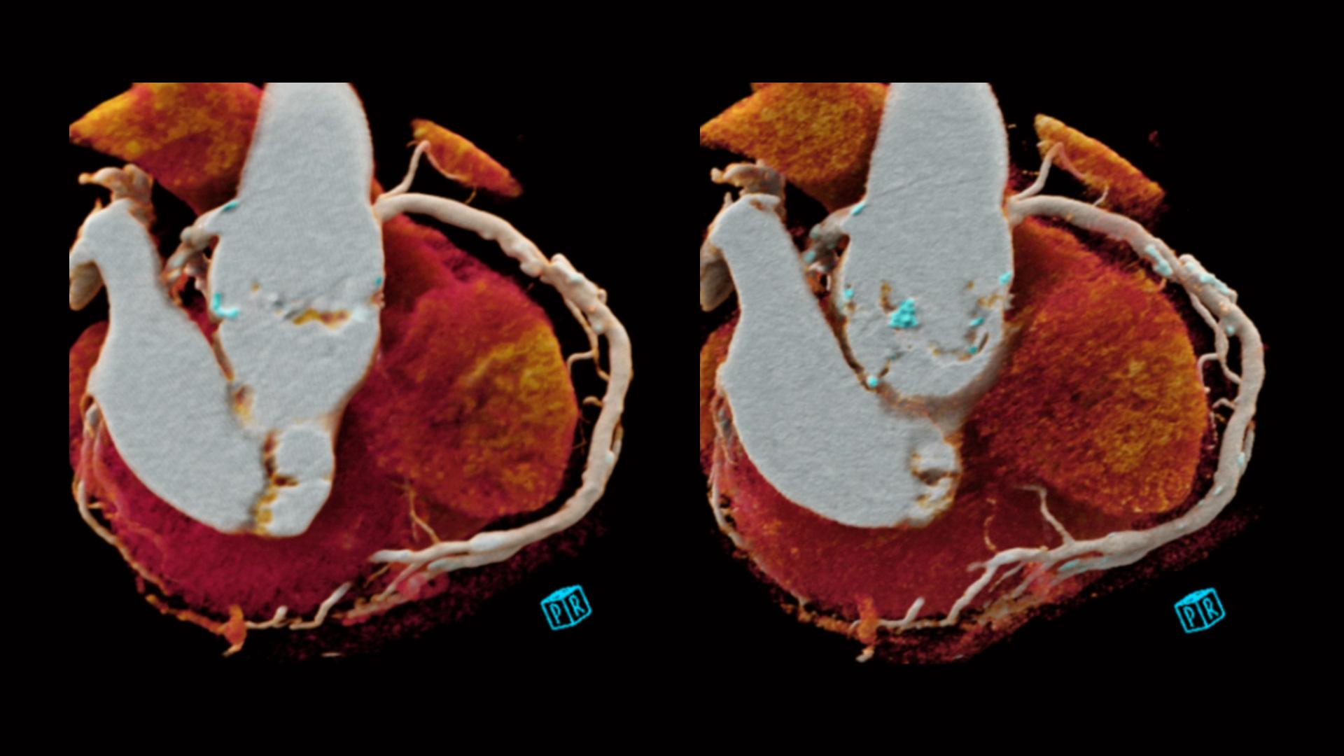 Coronary stenosis assessment prior to a transcatheter aortic valve ...