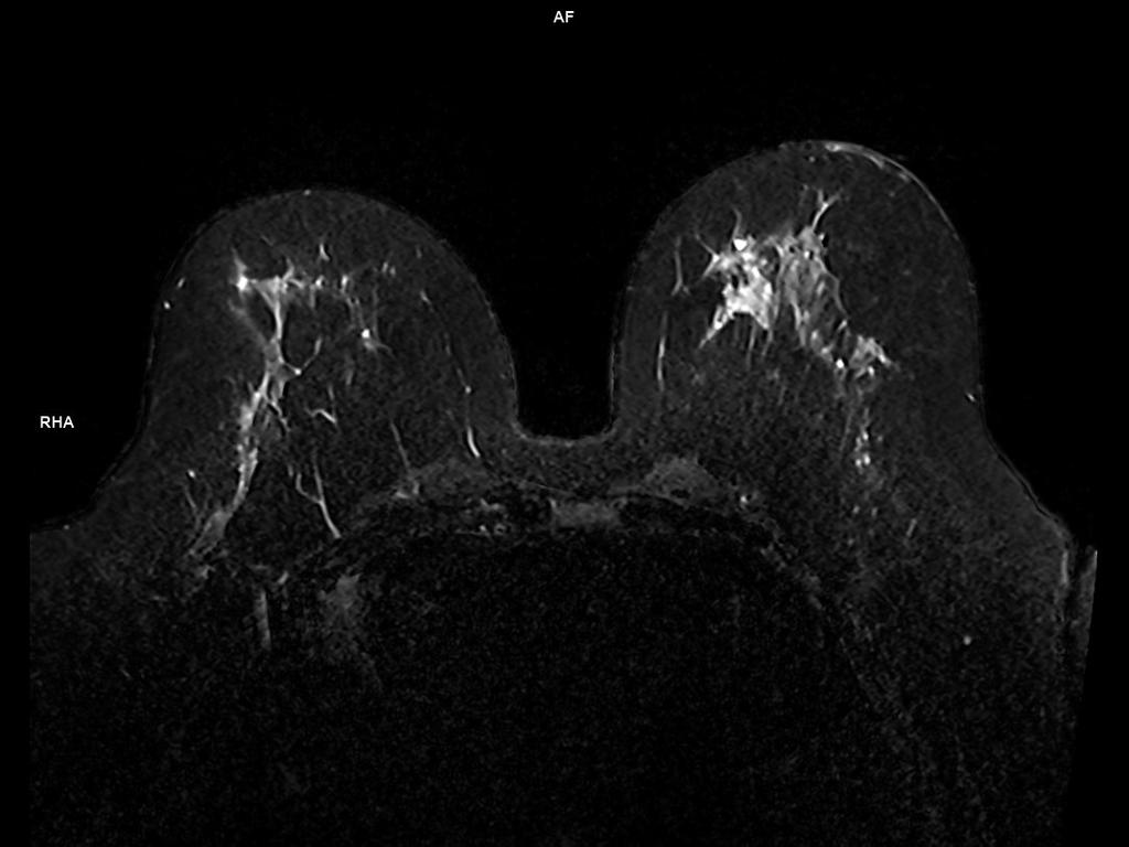 Axial T2 Dixon-MAGNETOM Lumina - Siemens Healthineers USA