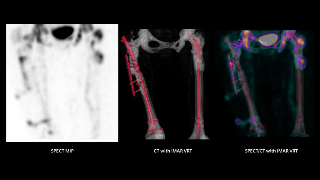 SPECT/CT in musculoskeletal medicine - Siemens Healthineers