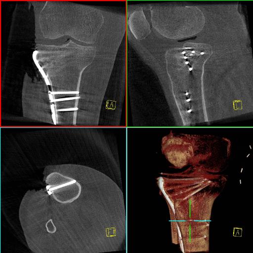 Tibia proximal - Siemens Healthineers Latinoamérica