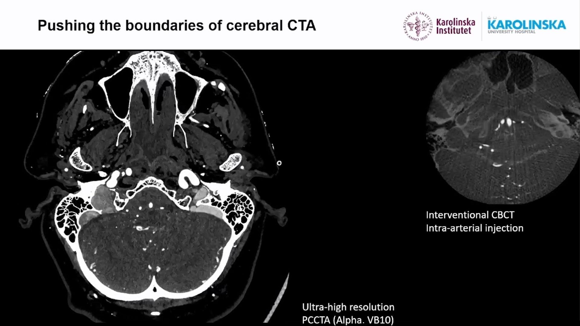 Clinical photon-counting CT. Expanding the boundaries of Neuroradiology ...