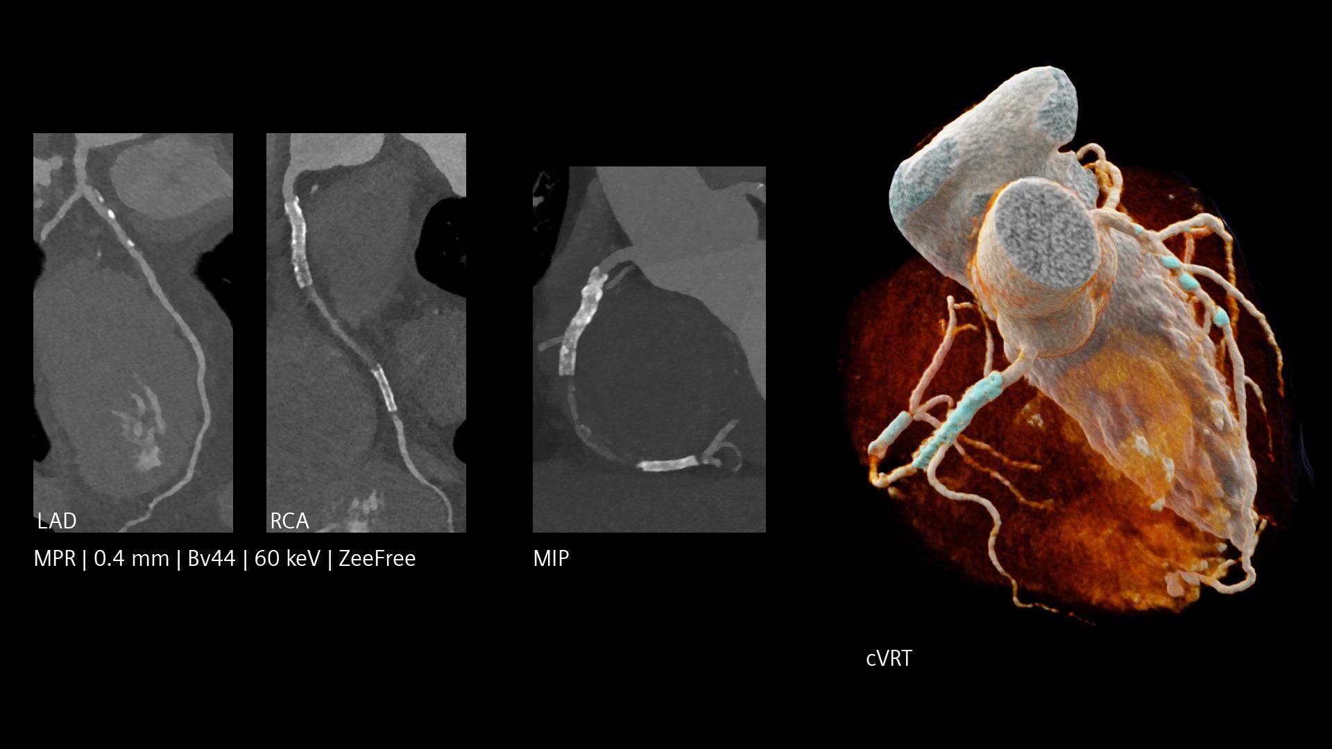 PCCT cardiovascular imaging - Siemens Healthineers