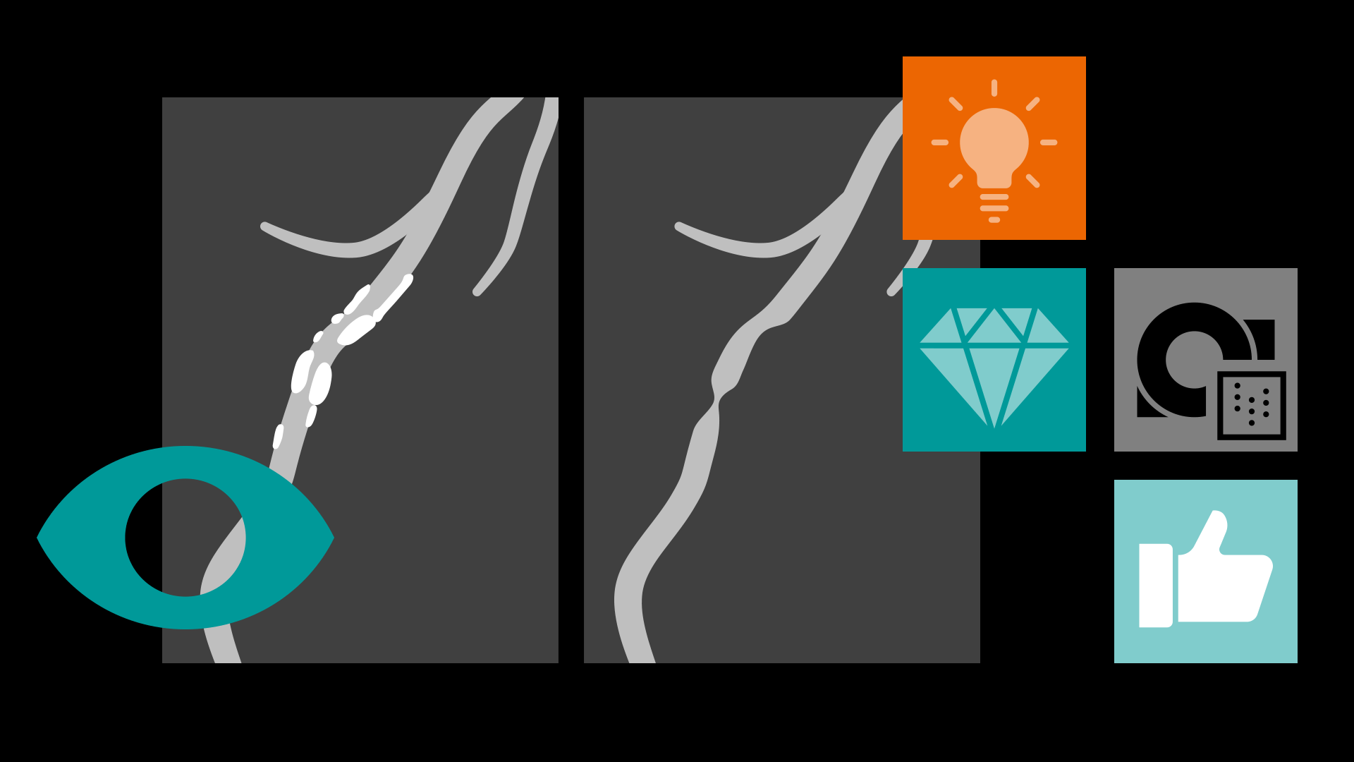 Virtual calcium removal in calcified coronary arteries with photon ...