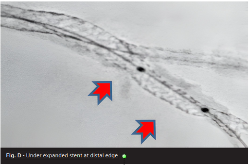 Advancing Coronary Bifurcation Stenting and Calcified Lesion Management