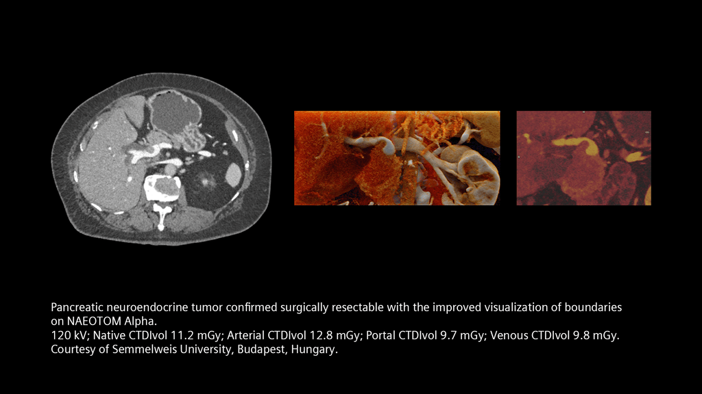 Computed Tomography for Oncology - Siemens Healthineers