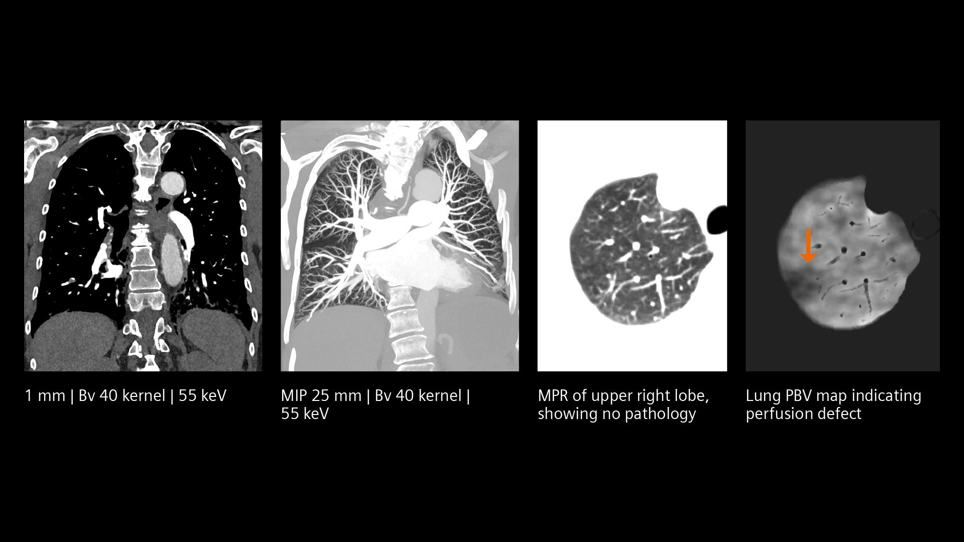 PCCT pulmonology imaging - Siemens Healthineers USA