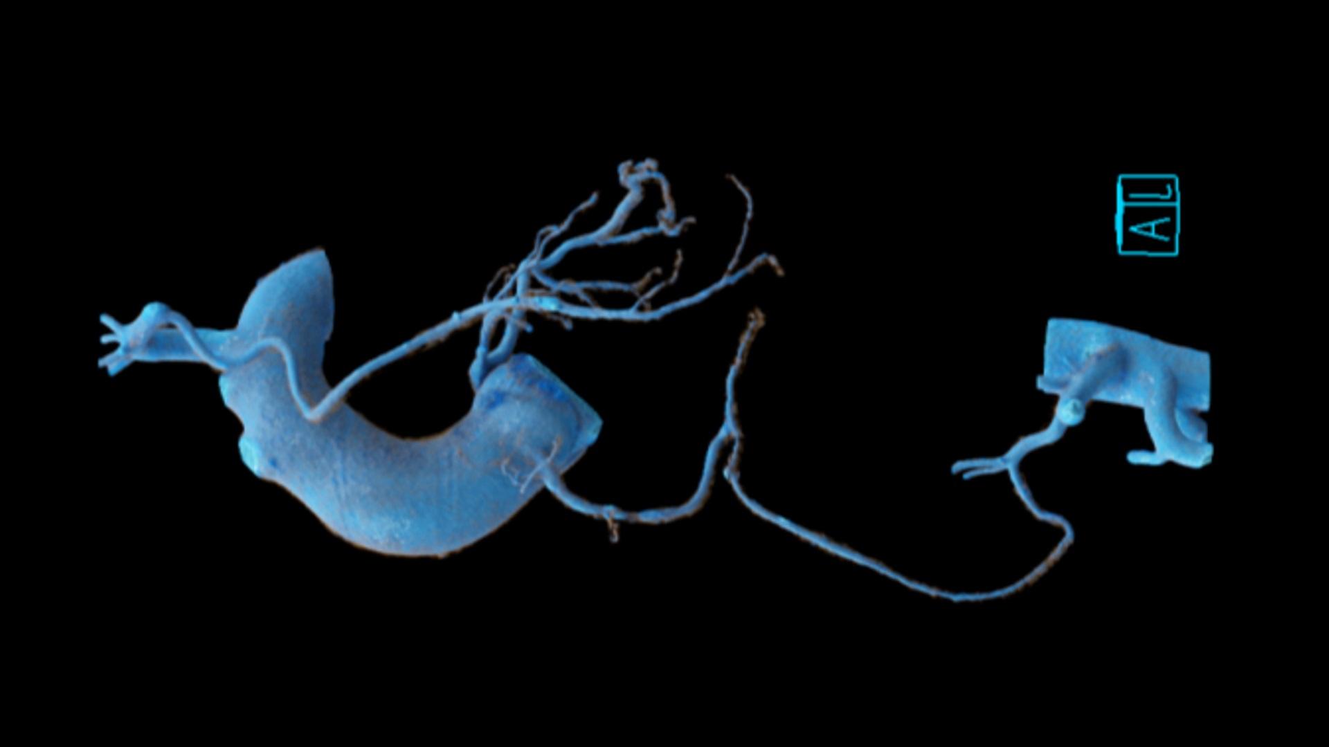 CABG of the right gastroepiploic artery and of the left internal ...