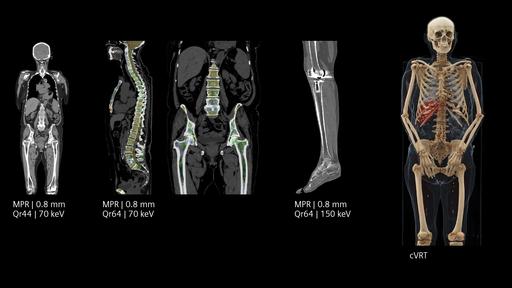 Photon-counting CT musculoskeletal imaging - Siemens Healthineers
