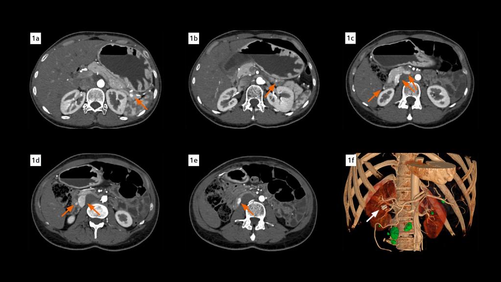 Multiple gastrinomas - Siemens Healthineers