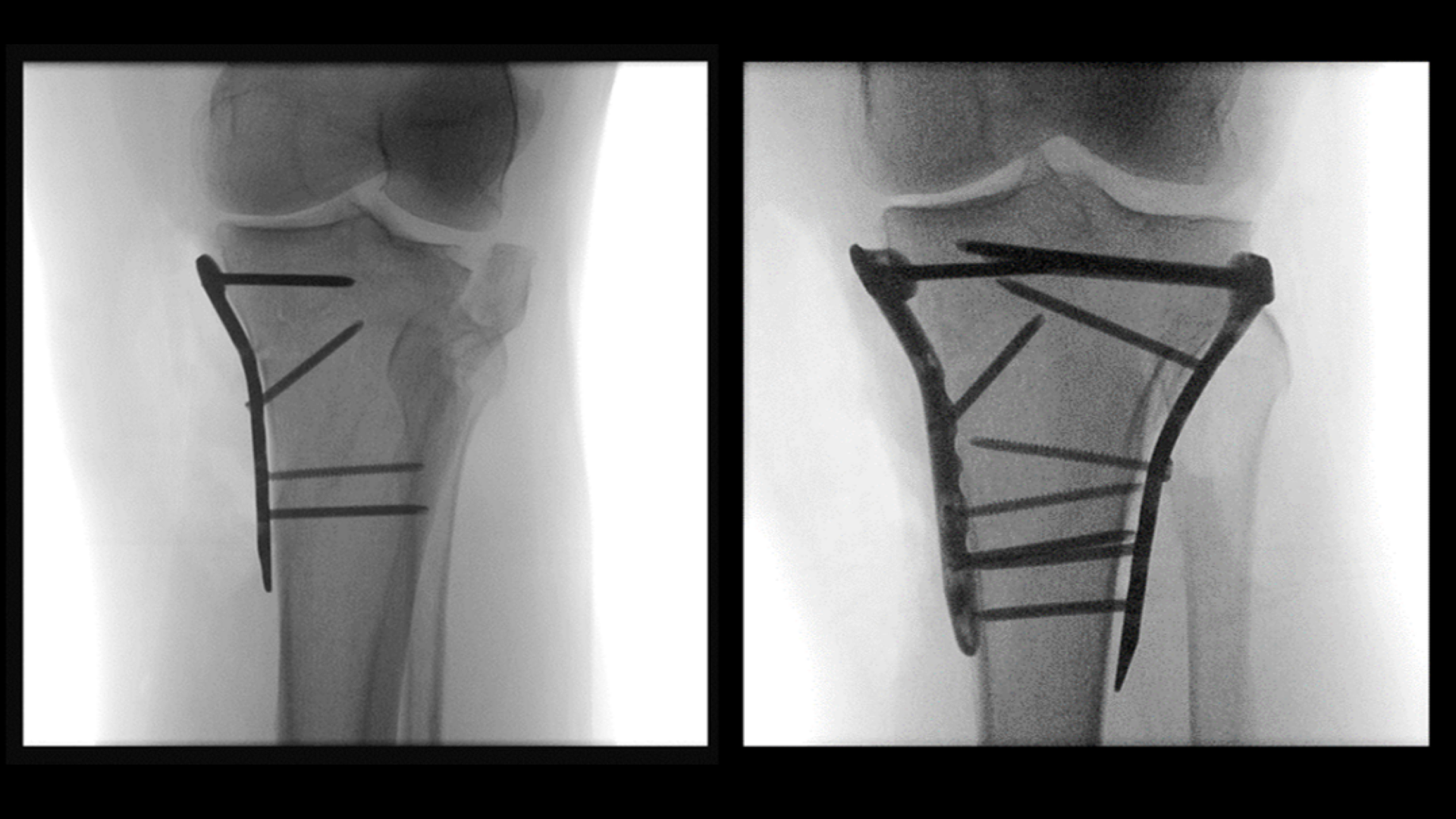 Mobile C-arm machine - CIARTIC Move - Siemens Healthineers