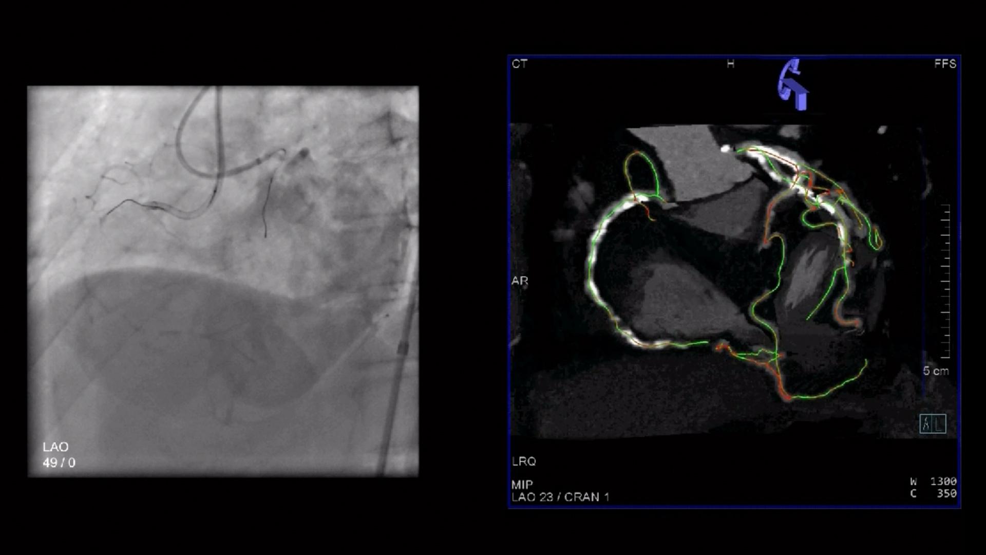 ARTIS icono – Angiography System – Siemens Healthineers - Siemens ...