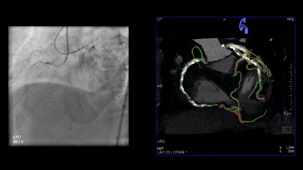 ARTIS icono – Angiography System – Siemens Healthineers - Siemens ...
