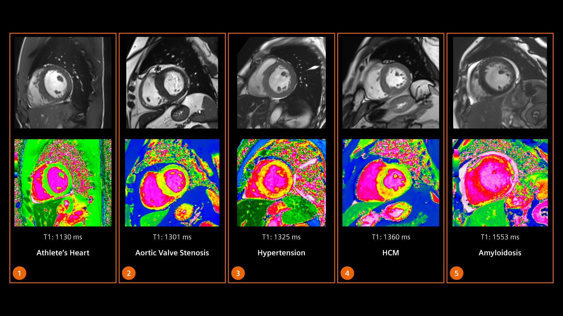 Cardiovascular MRI - Siemens Healthineers