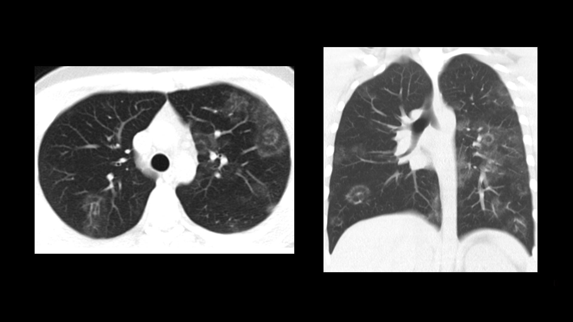 The target sign in COVID-19 pneumonia