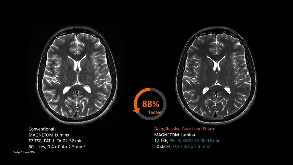 Deep Resolve - Siemens Healthineers