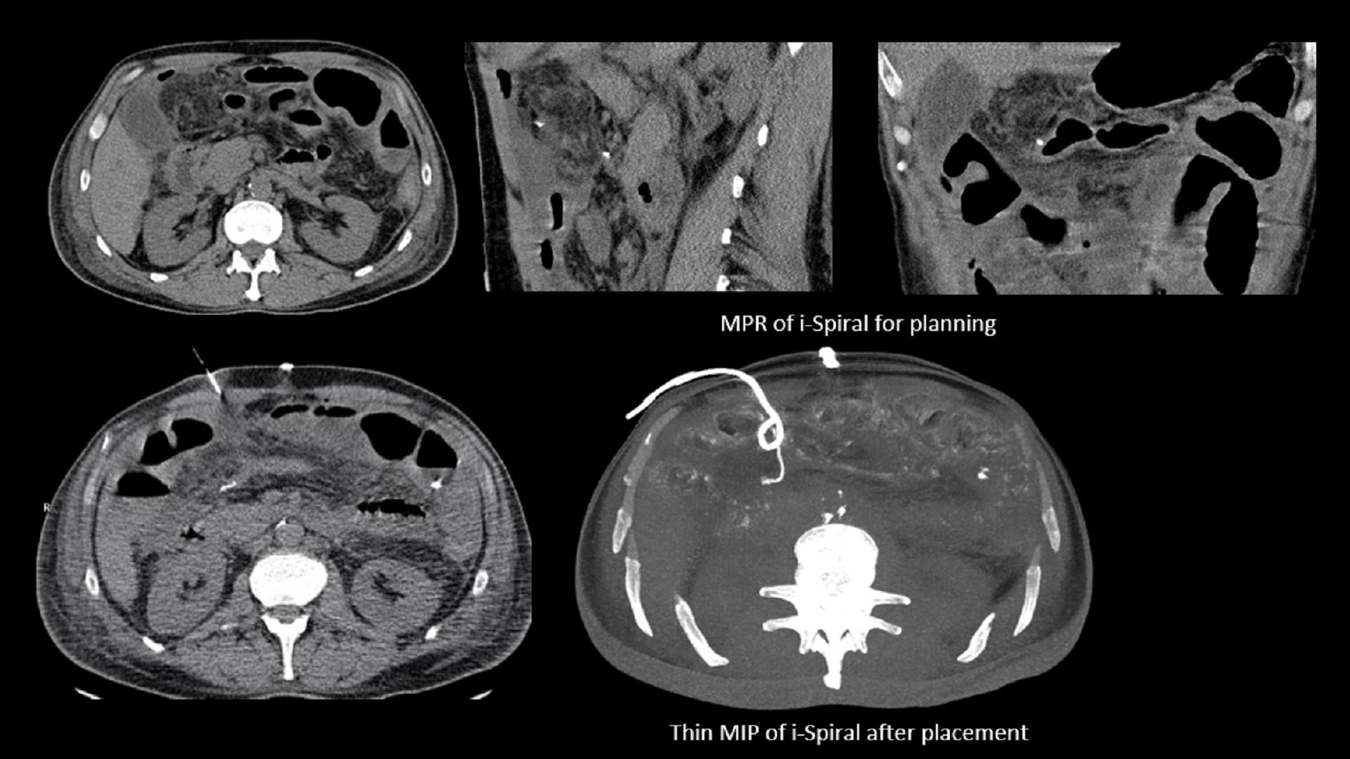 CT-guided interventions - Siemens Healthineers