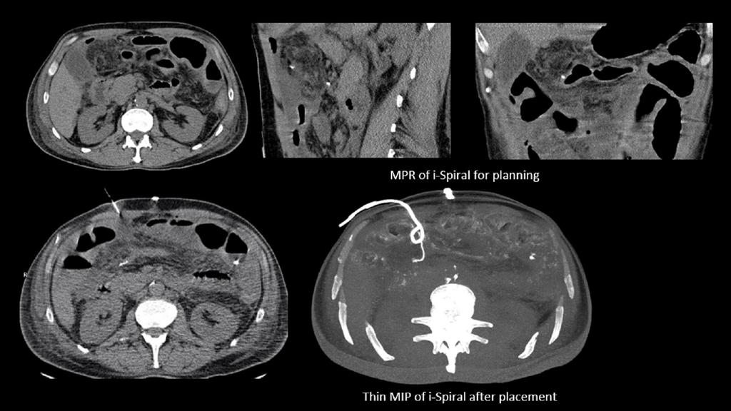 CT-guided interventions - Siemens Healthineers