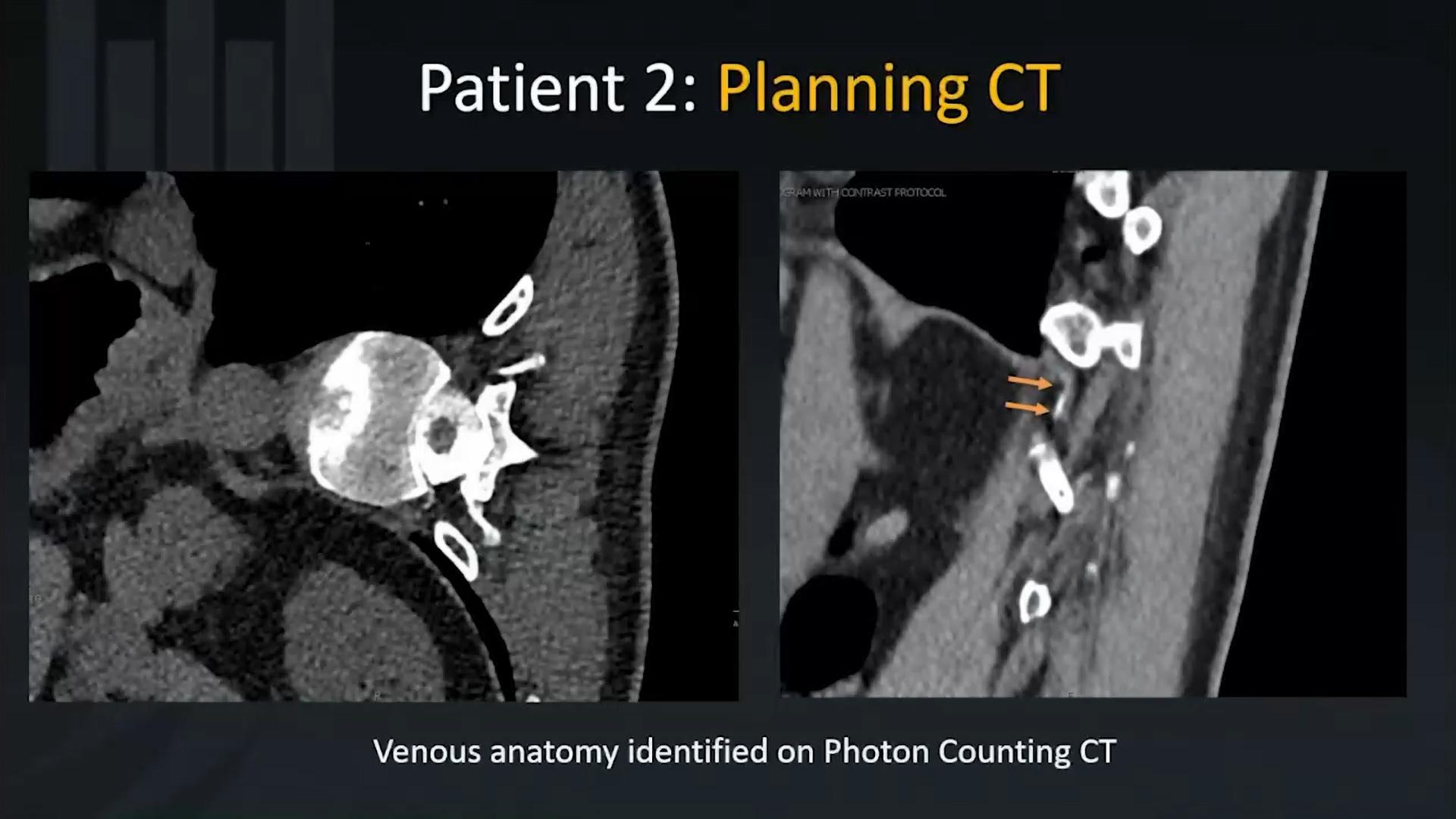 Photon-counting CT in Neuroradiology: SIH and the Elusive CSF-Venous ...