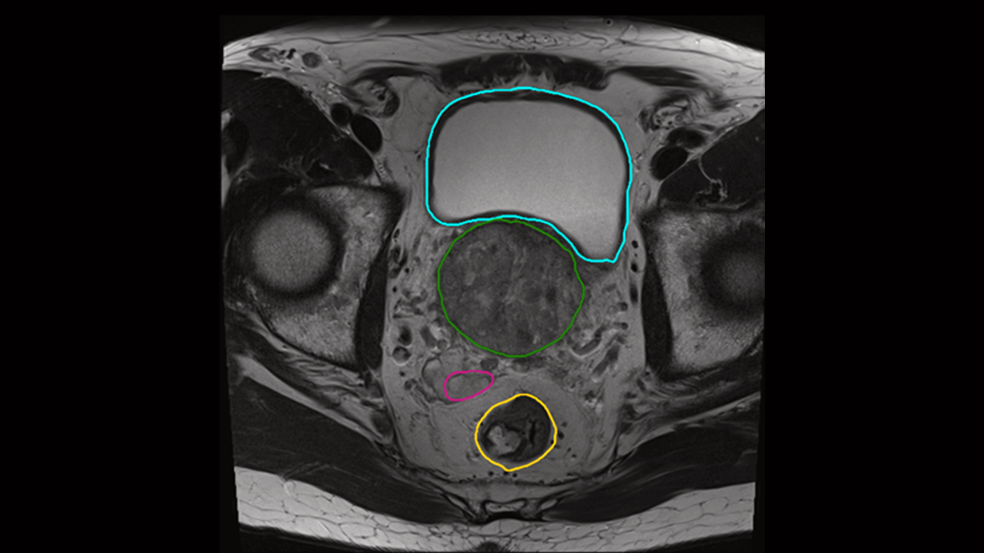 Autocontouring in radiation therapy - Siemens Healthineers - Siemens ...