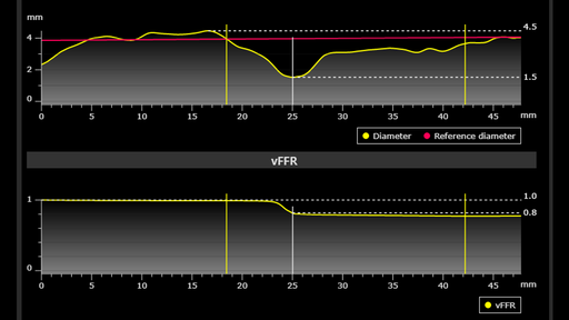 vFFR - angio-derived FFR measurements - Siemens Healthineers - Siemens ...