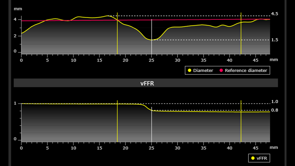 vFFR - angio-derived FFR measurements - Siemens Healthineers - Siemens ...
